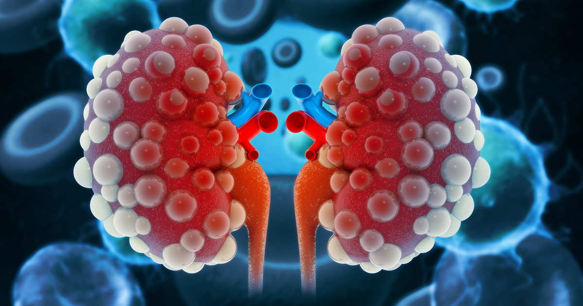 The future of Wilms tumor therapies - Children's National