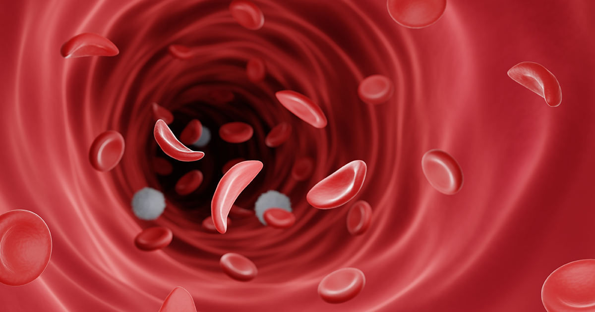 First-of-its-kind holistic program for managing pain in sickle cell ...