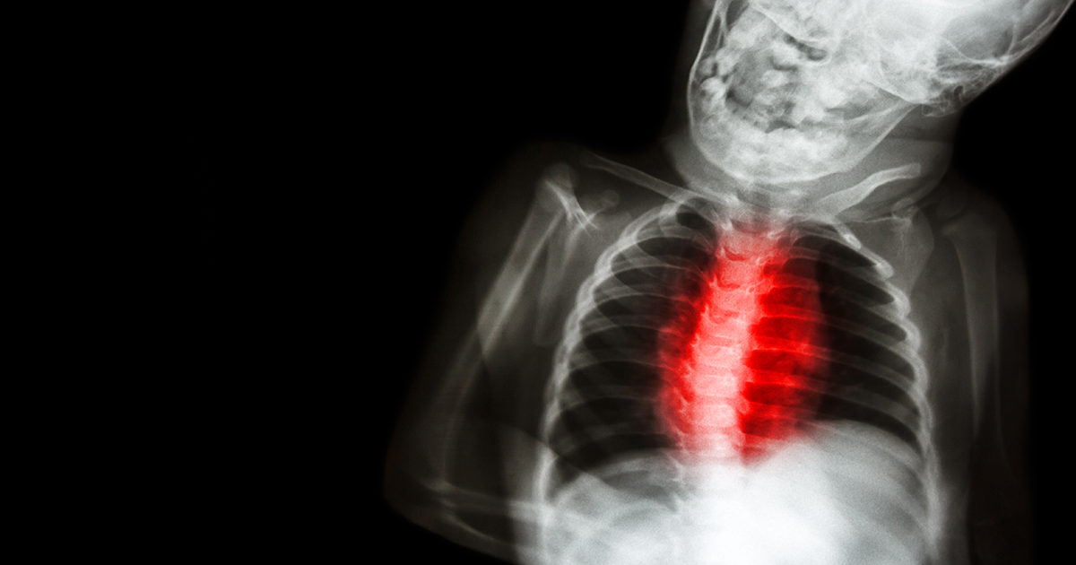 Cell therapy for neuroprotection in CHD - Children's National