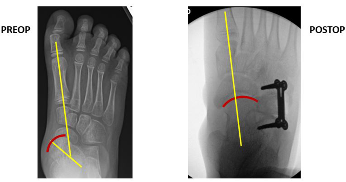 Innovative internal brace augmentation improves long-term foot ...