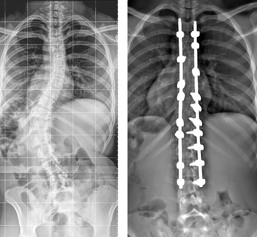 Innovations and learning in Spinal Fusion Surgical Home - Children's ...