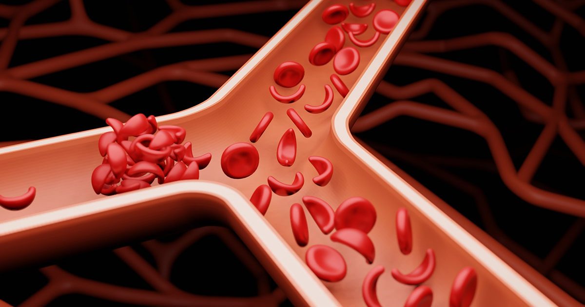 Children's National experts showcase sickle cell disease research ...