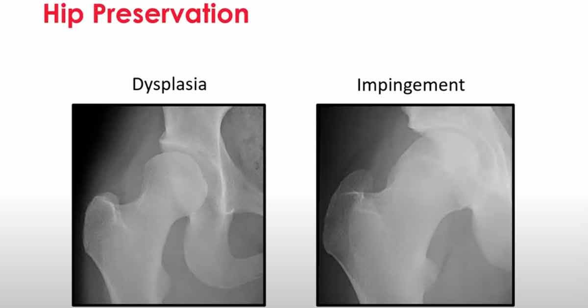 CME Webinar: Hip Preservation- Children's National