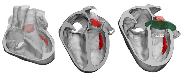 Living tissue heart valve transplant - Children's National