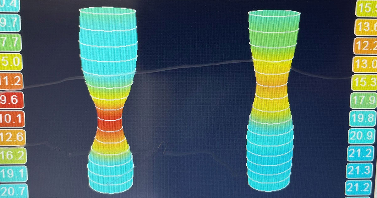 POEM shown as preferable first-line surgery for pediatric achalasia ...