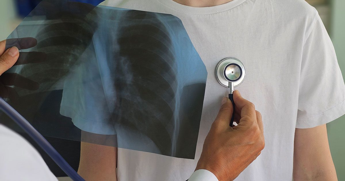 AI tool shows promise for faster, more accurate pediatric tuberculosis ...