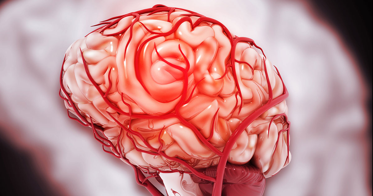 Recognizing cerebral clots in children with brain infections - Children ...