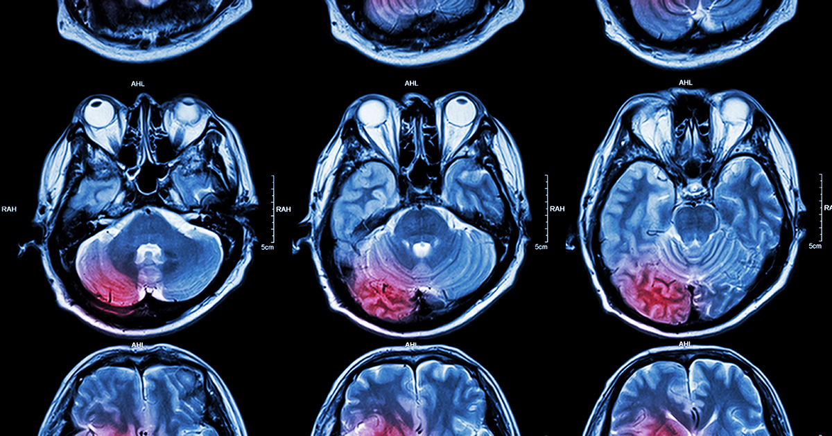 Study identifies distinct inflammatory signatures in pediatric ...
